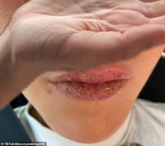 Woman Finally Realizes Why Her Lips Started To Rot - Newsiosity